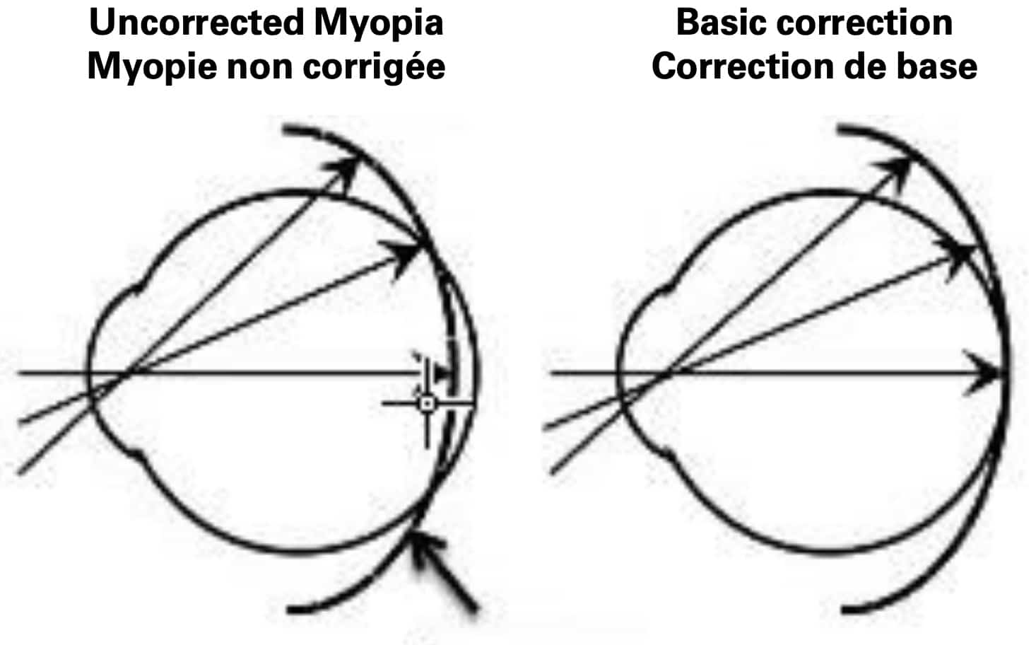 Childhood Myopia (part 3 of 4) - OptikNow